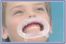 Ortho-Care (UK) Ltd Optragate Junior Disposable Lip and Cheek Retractors